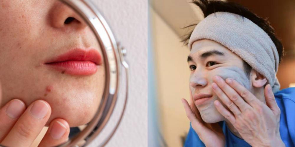 This Is Why You Keep Having Acne Breakout, And How To Avoid Them: